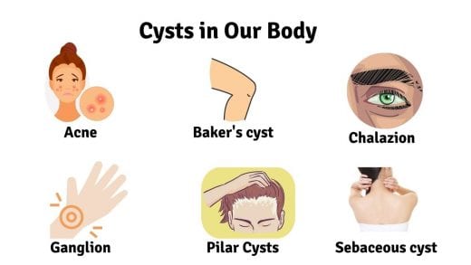 Types of Simple Cysts in Our Body - wiki Health News