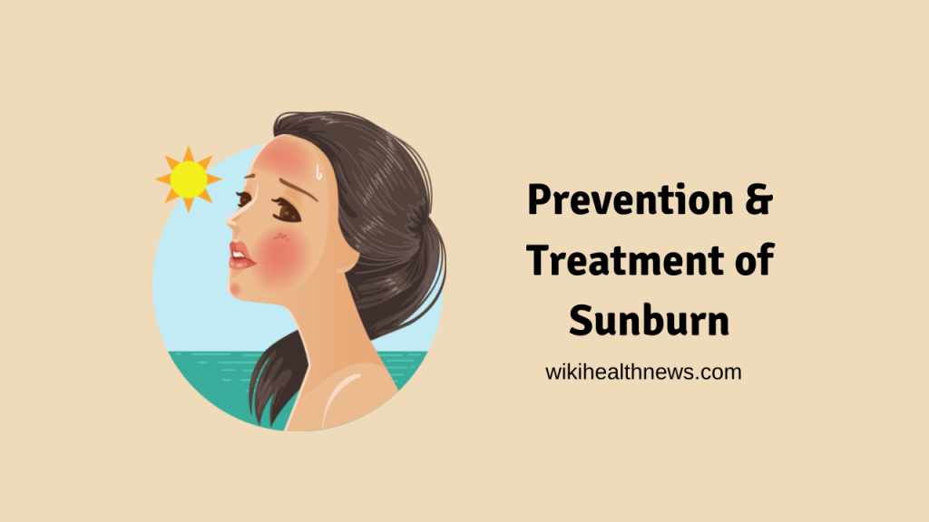 Sunburn Symptoms, Treatment & Prevention - wiki Health News