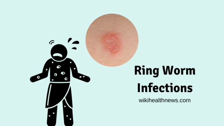 Ring worm Infection: Prevention & Treatment - wiki Health News